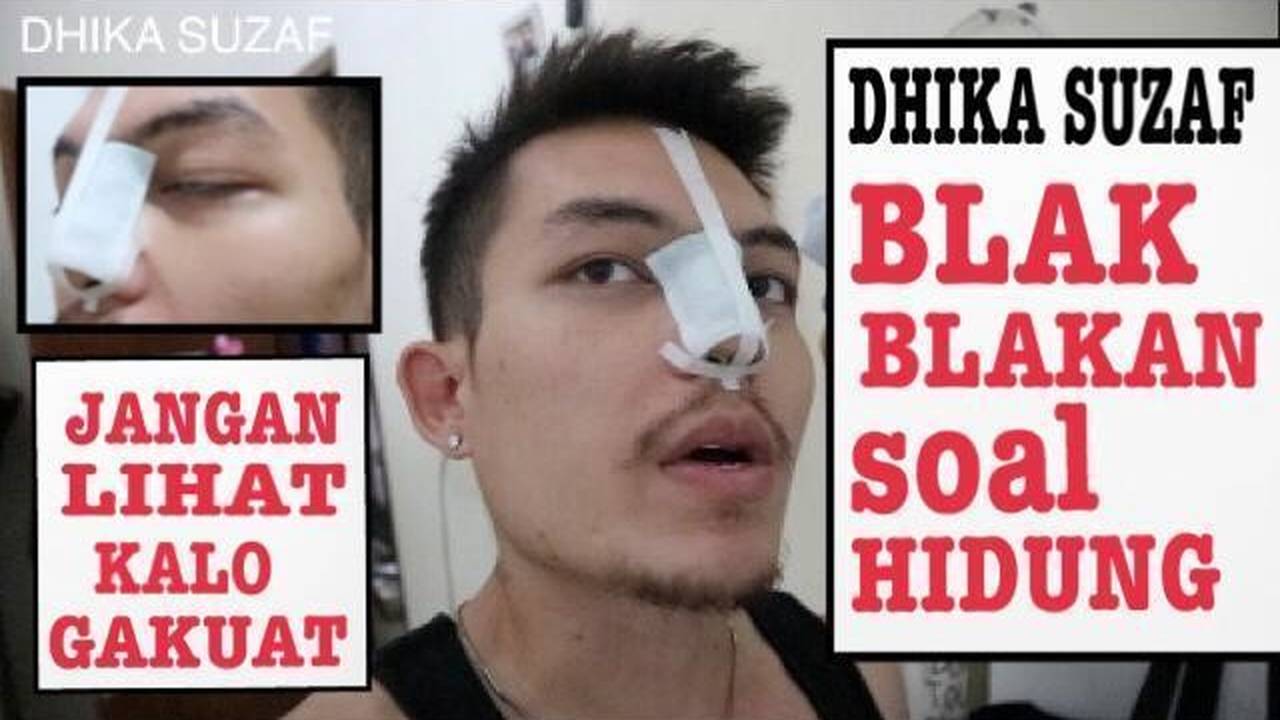 DHIKA SUZAF'S NOSE SURGERY AKA OPERASI IDUNG, SIAP DI BULLY ATAU DI ...