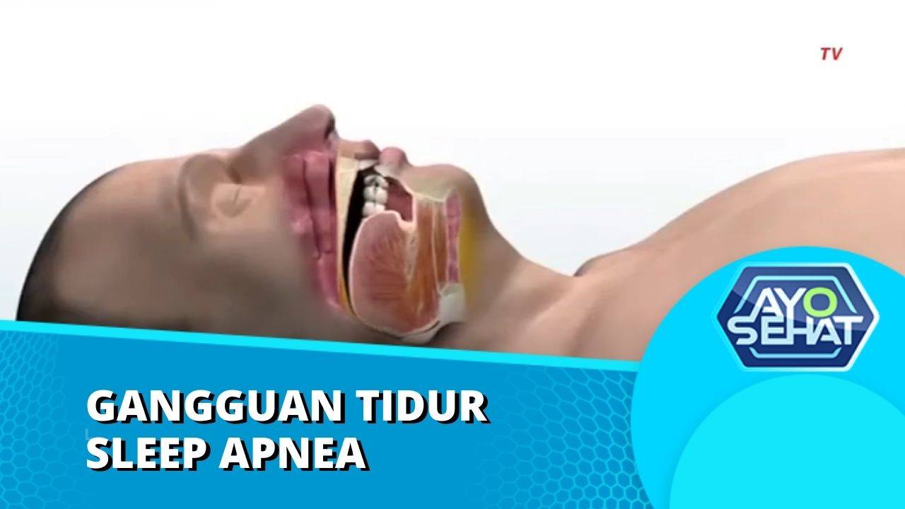 Gangguan Tidur Sleep Apnea Seperti Apa Itu AYO SEHAT Kompas TV