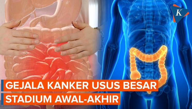 Nonton Video Kanker Usus Besar Stadium Akhir Terbaru | Vidio