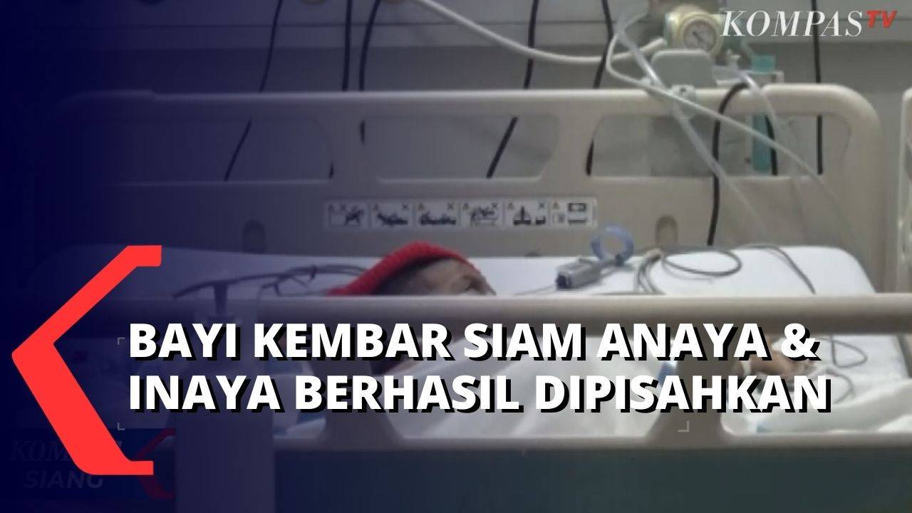 Bayi Kembar Siam Anaya dan Inaya Berhasil Dipisahkan, Kini Kondisinya Stabil - Kompas TV | Vidio