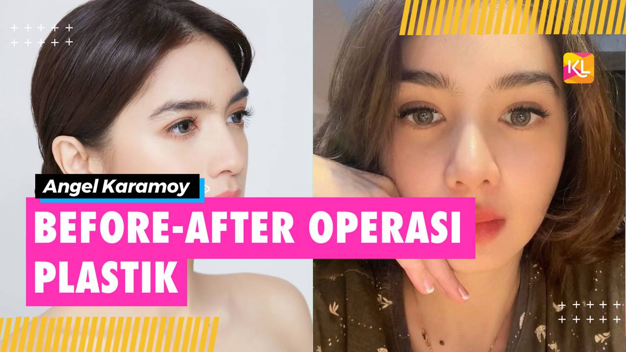 Before After Angel Karamoy Setelah Lakukan Operasi Plastik, Masih ...