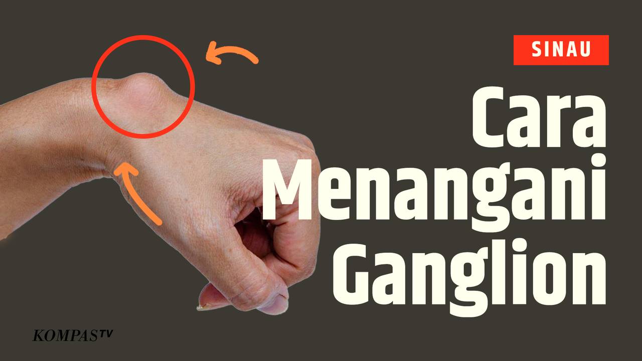 Apa itu Ganglion dan Bagaimana Cara Menanganinya?| SINAU - Kompas TV ...